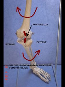 Le LCA du genou: différents mécanismes de rupture - CM2S