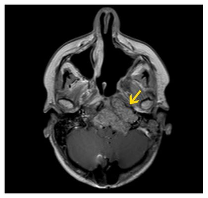 CHORDOME DU CLIVUS - imagerie.medicale.over-blog.com